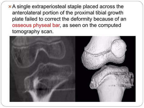 Physiological And Pathological Tibia Vara Ppt Death Injury Or Military Conflict Sensitive