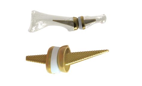 Addup And Anatomic Implants Produce The Worlds First 3d Printed Toe