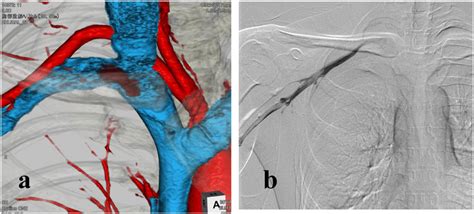 Preoperative Computed Tomography And Venography Of Patient 1 A Download Scientific Diagram