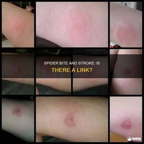 Spider Bite And Stroke Is There A Link Medshun