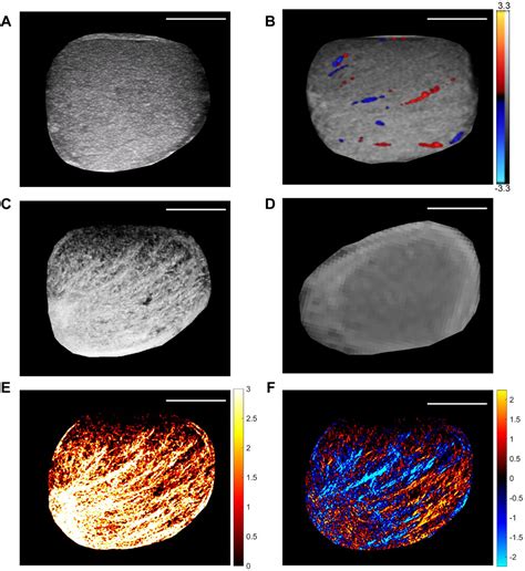 Super‐resolution Ultrasound Localization Microscopy For The Non‐invasive Imaging Of Human