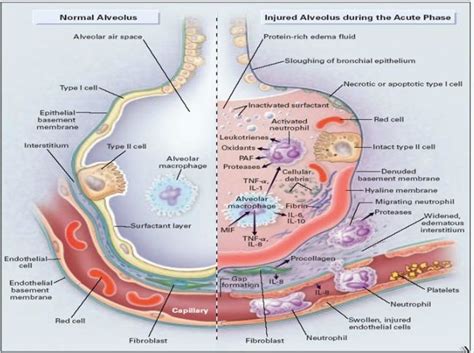 Ards Diffuse Alveolar Damage Egan Book Vrogue Co