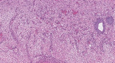 Endocervical Polyp Ottawa Atlas Of Pathology