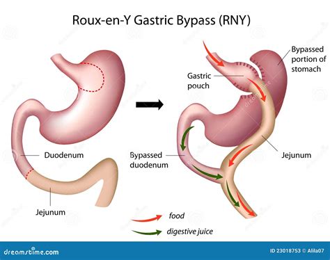 Roux En Y Gastric Bypass Surgery Stock Illustrations 11 Roux En Y