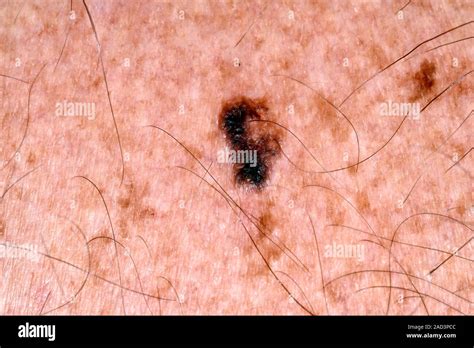 Seborrheic Keratosis Close Up Of A Seborrheic Keratosis Seborrheic Or