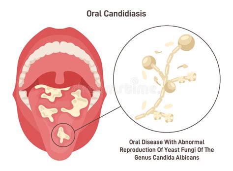 Candida Albicans Mouth