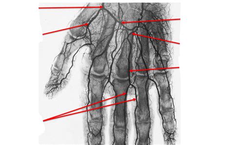 Hand Angiogram Diagram Quizlet