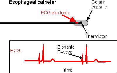 Esophageal Temperature Probe Placement Anesthetic Monitoring Devices