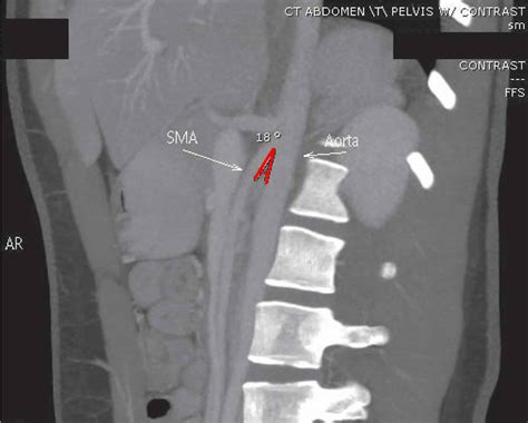 Mesenteric Artery Anatomy Function Branches And Mesenteric Artery Ischemia