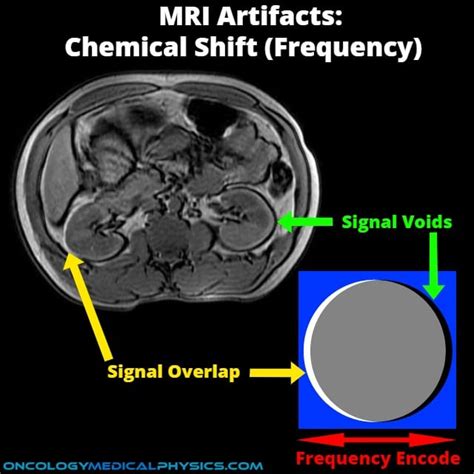 Mri Artifacts Oncology Medical Physics