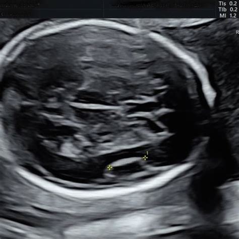 Cingulate Sulcus Length Measurement Download Scientific Diagram