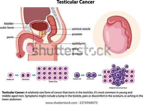 Illustration Male Anatomy Testicular Cancer Stock Vector Royalty Free