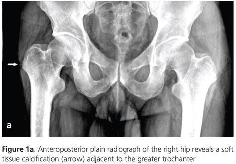 Acute Calcific Tendinitis Of The Gluteus Medius Türk Osteoporoz Dergisi Acute Calcific