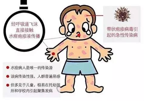 水痘防控知识宣教 后勤处