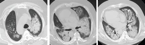 Lung Infiltrates And Fever Is It Pneumonia Or Not