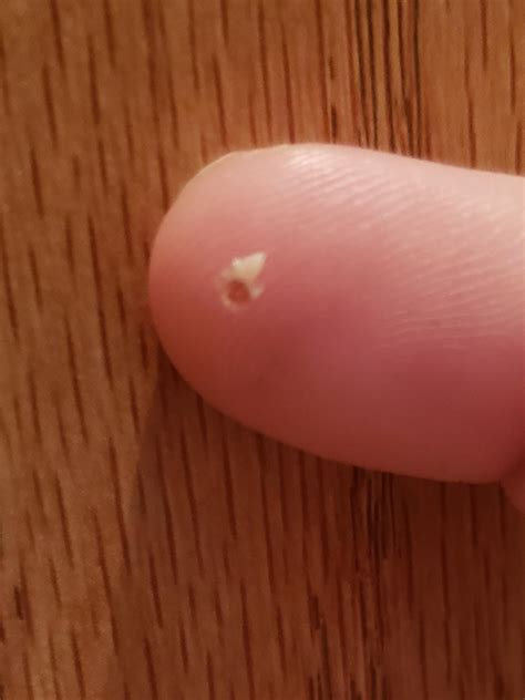 Scab That Wouldn T Go Away When I Picked It Today A Sac Came With It