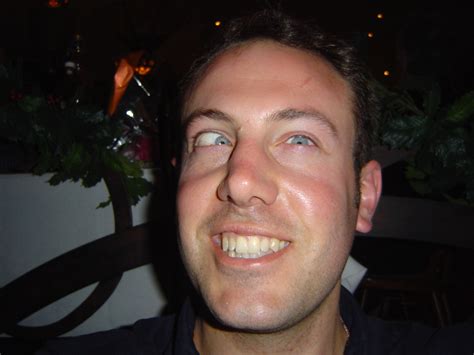 Esotropia Causes Symptoms Diagnosis Treatment And Prognosis