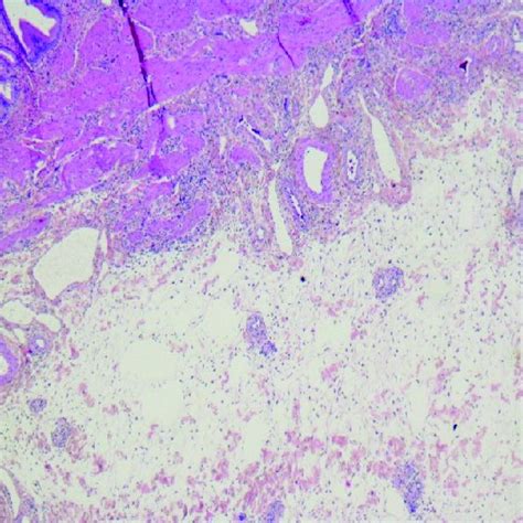 Pdf Strangulation Of The Floating Gallbladder By The Lesser Omentum