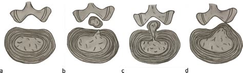 Ad Axial Images Show Normal Lumbar Disc Anatomy A A Sequestered