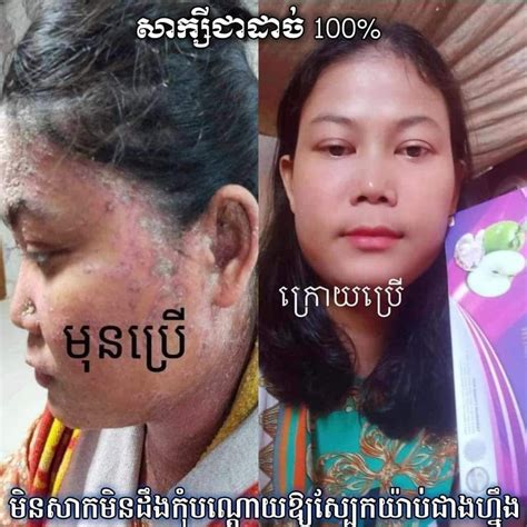 ដំណោះស្រាយស្បែកអាឡែកហ្ស៊ី Home