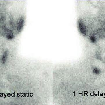 Sequential Planar Static Images Post Technetium 99m Sestamibi