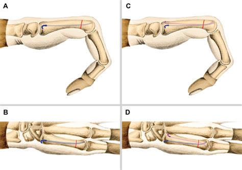 Ortho Globe Metacarpal Fractures
