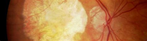 Manchester Vision Network Retinal Degeneration