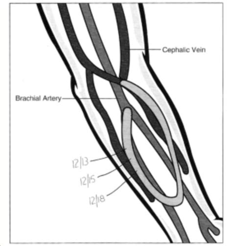 Bedside Cannulation Chart Show Ing Dates And Locations Of