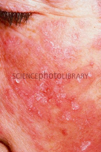 Systemic Lupus Erythematosus Swc Healthcare