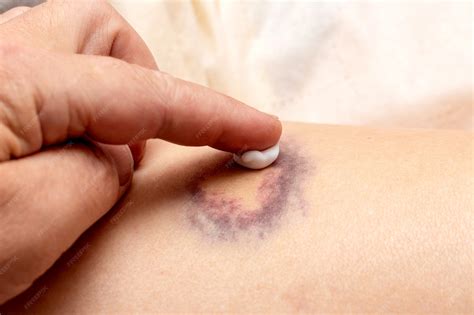 Hematoma Definition