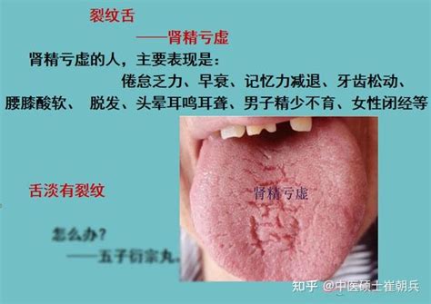 舌头有裂纹5种原因9种舌象看看你是属于哪一种 知乎