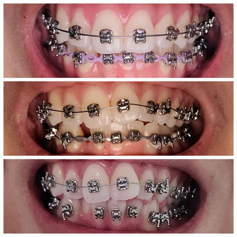 3 Month Progress R Braces
