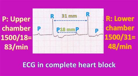 How To Check Heart Rate From The ECG All About Heart And Blood Vessels