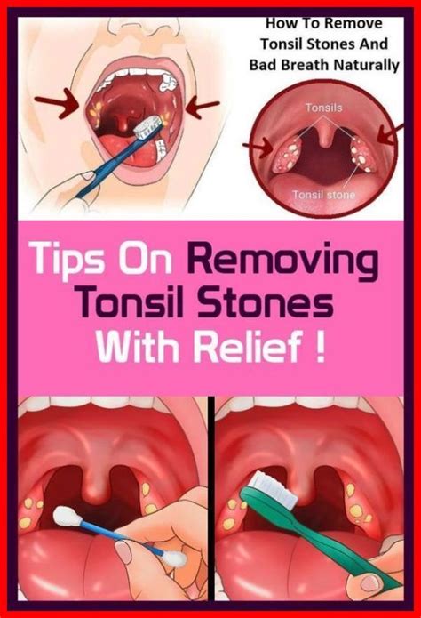 Tonsillectomy Recovery For Adults Day By Day Artofit