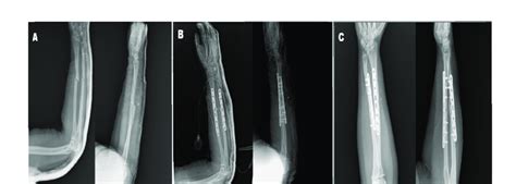 Plate Osteosynthesis A Preoperative Radiograms B Postoperative