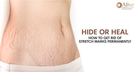 Cream To Get Rid Of Stretch Marks Complete Guide And Key Details Taft