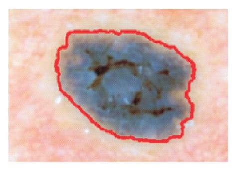 Dermoscopic Image Segmentation Using Region Growing Method A