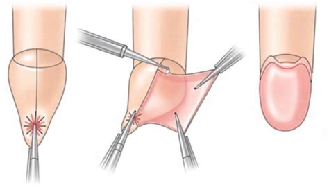 Phimosis Treatment