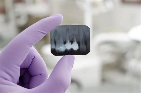 Can Dental X Rays Detect Cavities Between Teeth Rebecca E Reeves Dmd Ficoi Pa