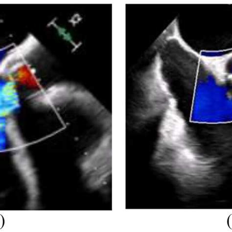 Transesophageal Echocardiography Showing Diastolic Transvalvular Aortic