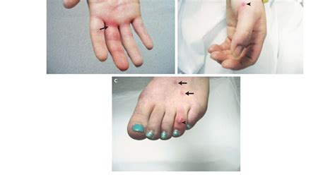 HÌnh Ảnh LÂm SÀng VÀ ChẨn ĐoÁn HÌnh Ảnh Disseminated Gonococcal Infection