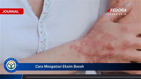 Ketahui Cara Mengatasi Eksim Basah Dengan Cepat Dan Alami