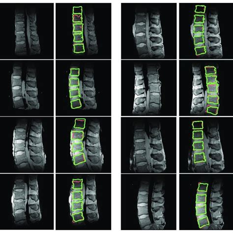 Segmentation Results For Other Magnetic Resonance Mr Spine Images
