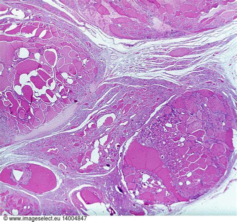 Multinodular Colloid Goiter Multinodular Colloid Goiter Bronchocele