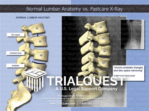 Normal Lumbar Anatomy Vs Fastcare X Ray Trialquest Inc