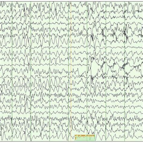 Continuous Electroencephalographic Eeg Monitoring Is An Effective