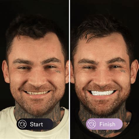 Nanofill Composite Bonding® What You Need To Know Uk Costs