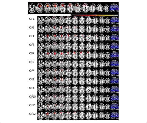 Lesion Reconstructions Of The Orbitofrontal Cortex Lesion Group