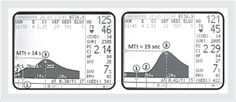 Analysis Of Thermodilution Curves — Cross Talk Phenomenon Example Of Download Scientific