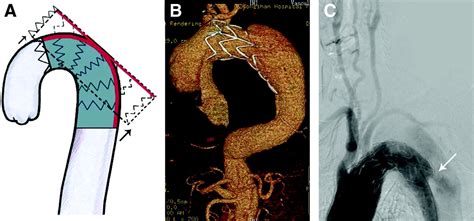 Retrograde Type A Aortic Dissection After Endovascular Stent Graft